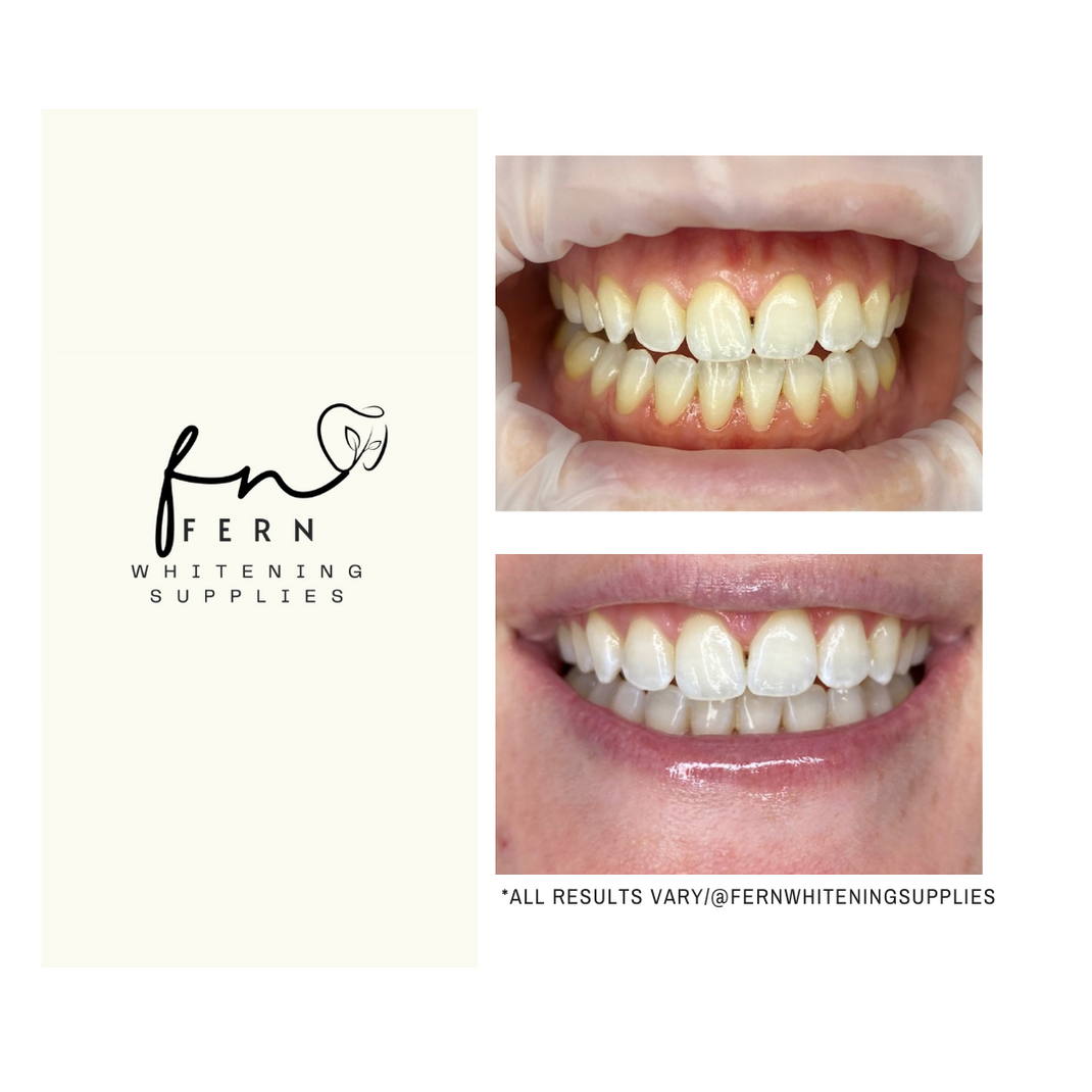 Wholesale Teeth Whitening Supplies – Fern Whitening Supplies
