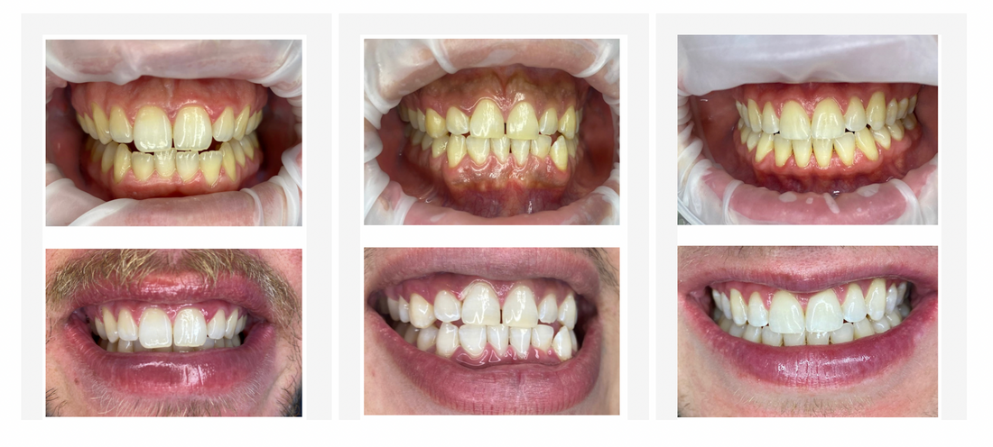 Teeth Whitening Supplies – Fern Whitening Supplies